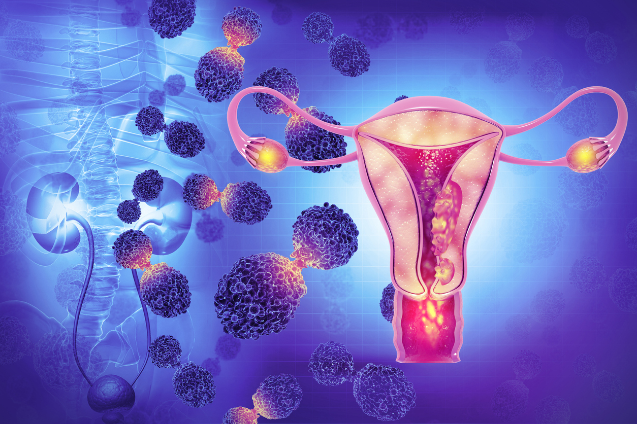 Early diagnosis of cervical and endometrial cancer | RCGP Learning